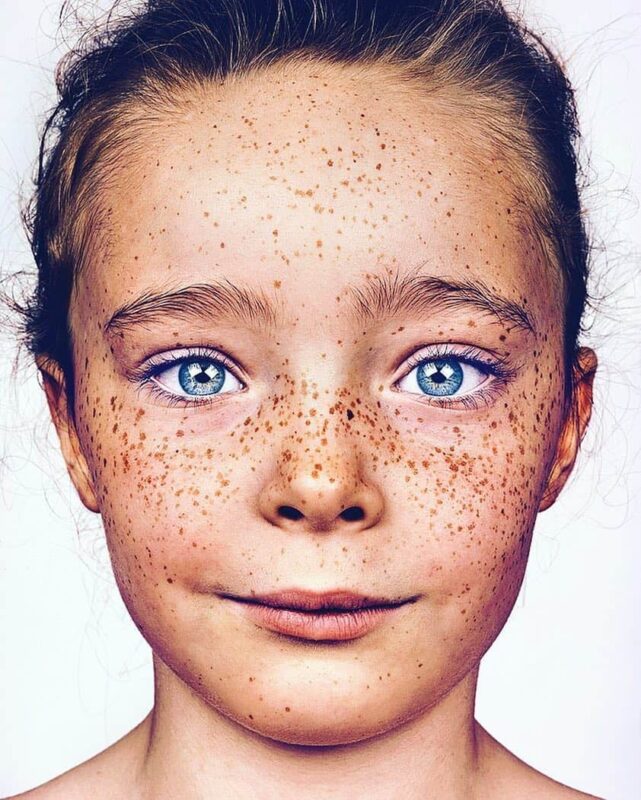 #Freckles - Unique Portrait Series Showing Beauty Of Freckled ...