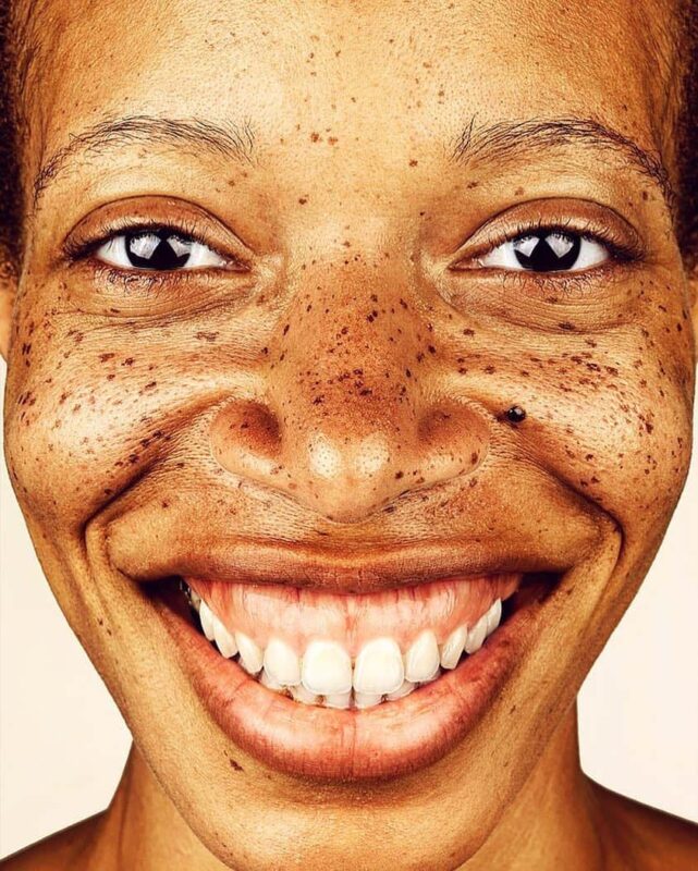 #Freckles - Unique Portrait Series Showing Beauty Of Freckled ...