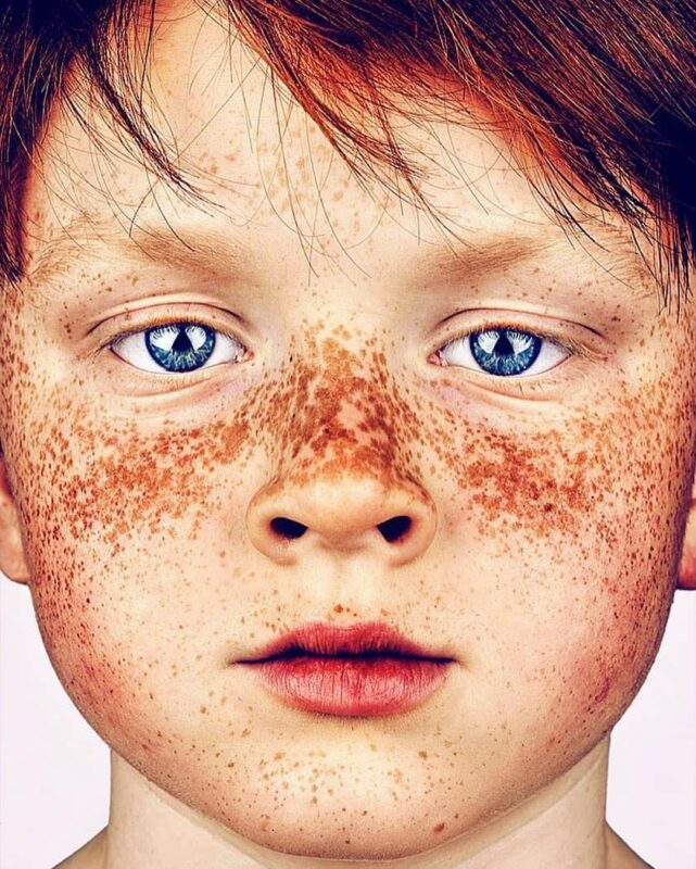 #Freckles - Unique Portrait Series Showing Beauty Of Freckled ...